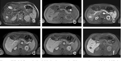 Table 1 From Imaging Features Of Intrahepatic Cholangiocarcinoma In Gd