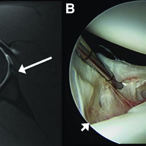 Right Shoulder Magnetic Resonance Arthrogram And Corresponding