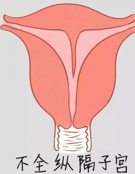 子宮畸形的三種情況：縱膈子宮、雙角子宮和雙子宮 每日頭條