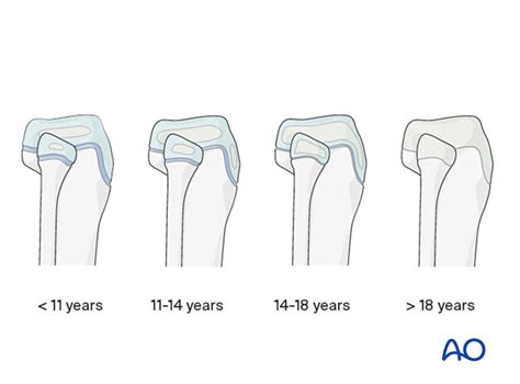 Avulsion Of The Apophysis