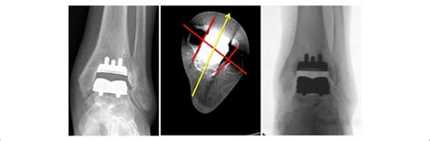 Case Example Of A 68 Year Old Female Patient With Medial Gutter