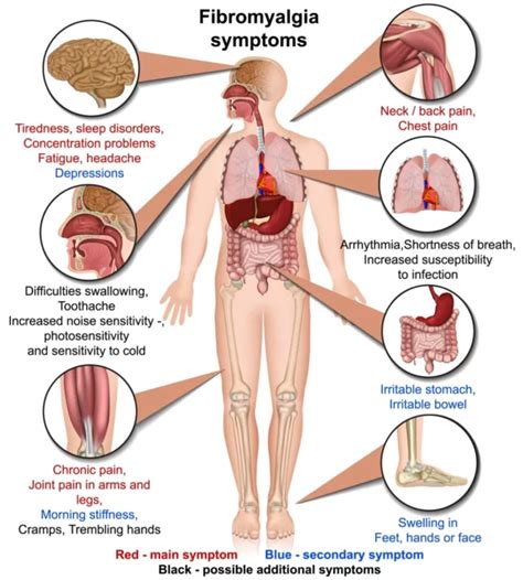 Is Fibromyalgia An Autoimmune Disease