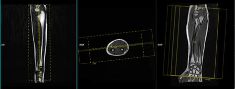Forearm Mri Protocols And Planning Indications For Mri Forearm