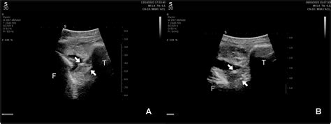 Integration Of Anterior And Posterior Ultrasonography For Comprehensive