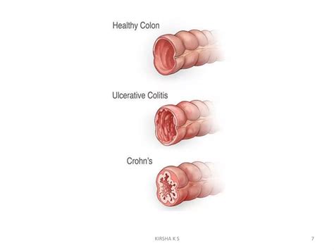 Inflammatory Bowel Disease Pdf Digestive Disorders Diseases And