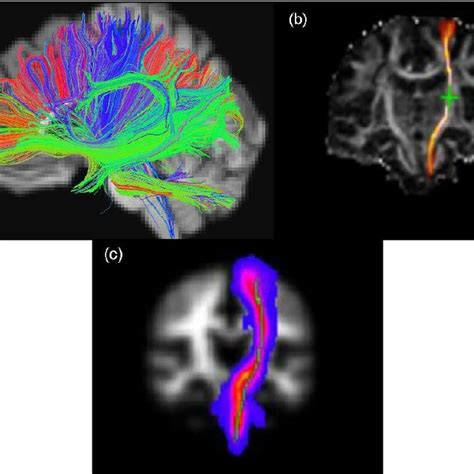 An Example Of Diffusion Tensor Magnetic Resonance Imaging Dt Mri Download Scientific Diagram