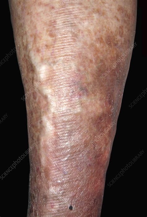 Pigmented Purpuric Dermatosis Stock Image C0529858 Science Photo
