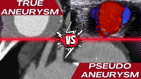 True Aneurysm Vs Pseudoaneurysm Youtube
