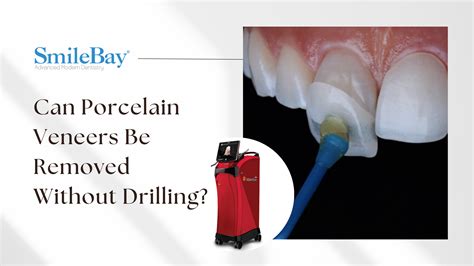 Can Porcelain Veneers Be Removed Without Drilling
