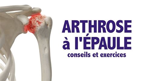 Arthrose à Lépaule Conseils Et Exercices Arthrose Epaule Trucs Et