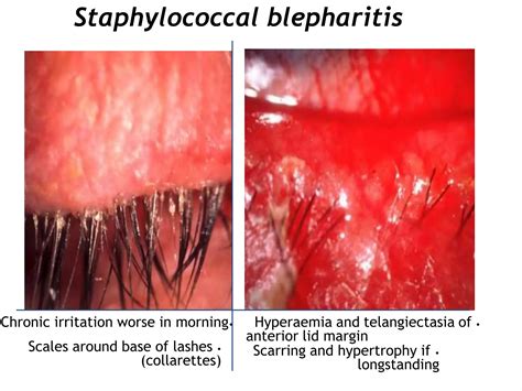 Blepharitis Pptx
