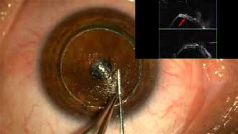 Intraoperative Oct Control Of The Depth Of The Intrastromal Canal By Download Scientific