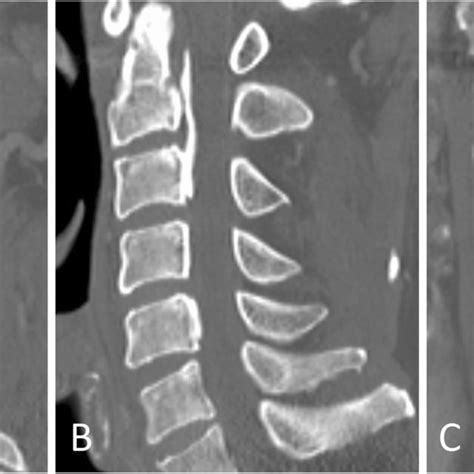 Subtype F2 Facet Fracture With Potential For Instability Either