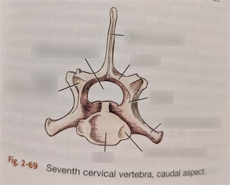 7th Cervical Vertebrae The Abcs Of Reading C Spine Cts Core Em