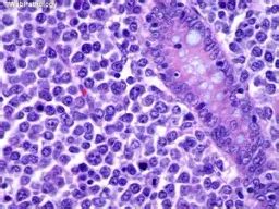 Diffuse Large B Cell Lymphoma