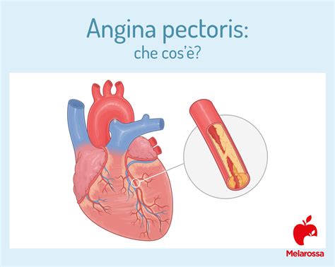 Angina Pectoris Cosè Cause Sintomi Diagnosi Cure