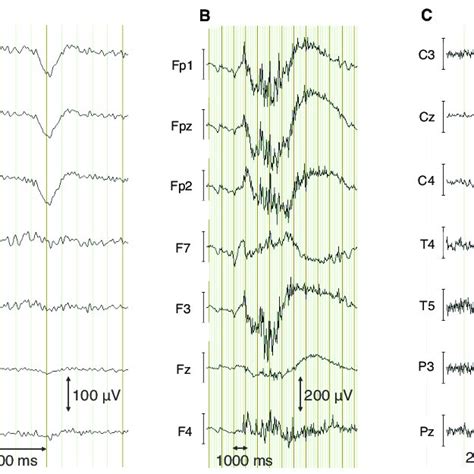 19 Panel A Example Of Ocular Artifacts Due To Eye Blinks The Frontal Download Scientific