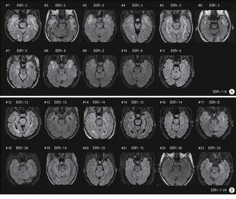 Figure 2 From Elderly Cadasil Patients With Intact Neurological Status Semantic Scholar