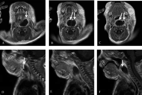 Mri Showed A Double Abscess With An Air Bubble Sign Arrow A C Download Scientific