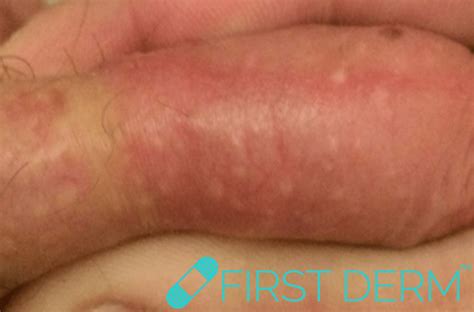 Sex Rash Weird Skin That Shows Your Partner Girlfriend Boyfriend