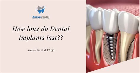 How Long Do Dental Implants Last Anaya Dental