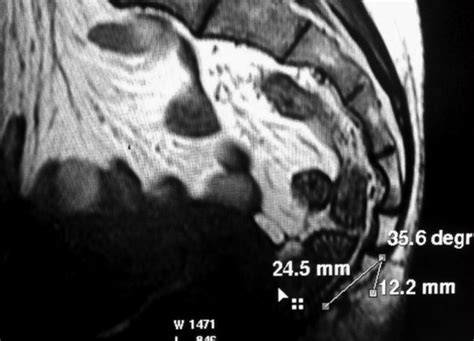 Magnetic Resonance Measurements Of Sacrococcygeal And Intercoccygeal