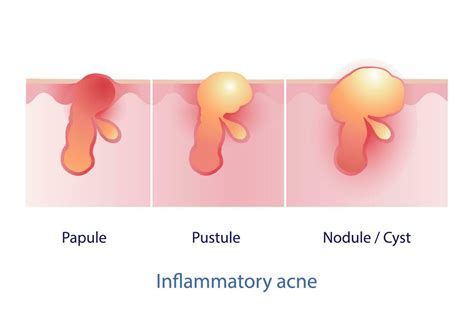 Types Of Inflammatory Acne Vector On White Background Papule Pustule