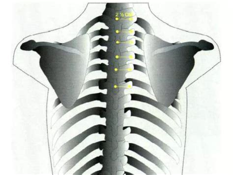 Ultrasound Guided Thoracic Paravertebral Block Pptx