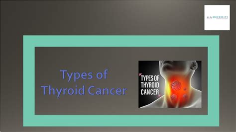 PPT Types Of Thyroid Cancer PowerPoint Presentation Free Download ID 12171208