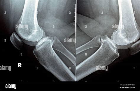 Plain X Ray On Knee Joint Showing Joint Space Narrowing And Subchondral Sclerosis On Medial