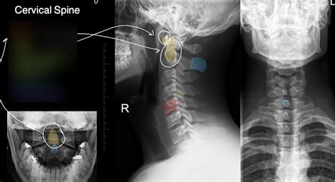 Block 1 Cervical Spine X Ray Diagram Quizlet