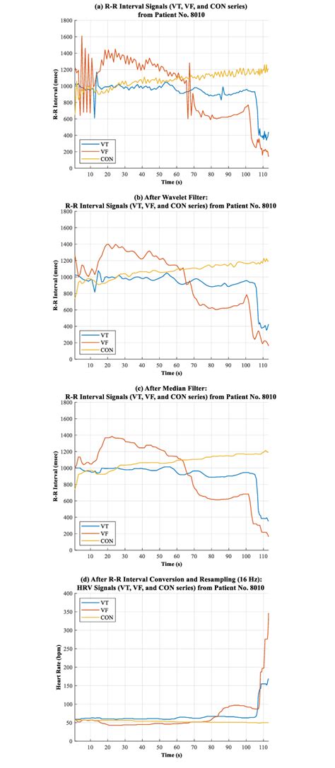 Pre Processing Of Signals From Patient 8010 Including Noise Reduction Download Scientific