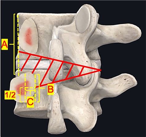 Foraminotomy Vs Laminectomy