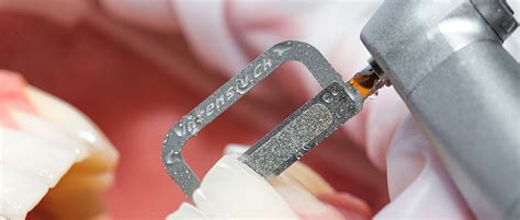 Kontrollerad Och Effektiv Ipr Stripping Nyhetsarkiv Dental24