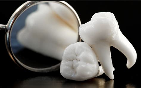 How Many Roots Do Wisdom Teeth Have And Why It Matters Teethandtooth