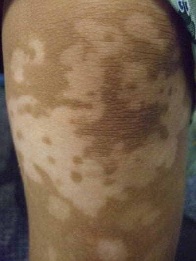 Hypopigmented Patches Dermatology Advisor