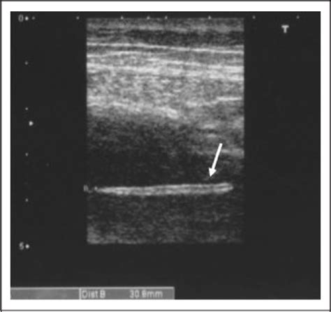 Abdominal Wall Abscess Semantic Scholar