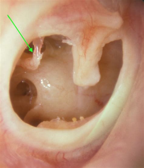Perforated Eardrum And Eardrum Repair — Mr Daniel Tweedie Consultant
