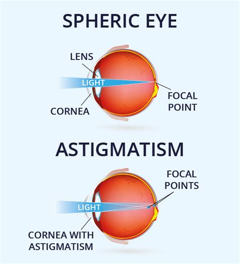Astigmatism Southland Eye Associates