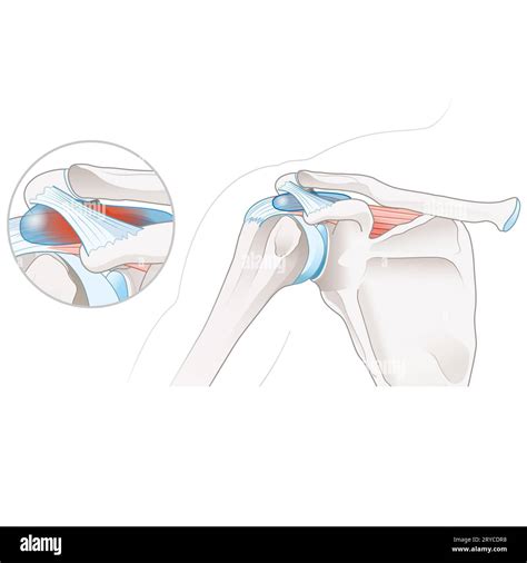 Shoulder Impingement And Subacromial Bursitis