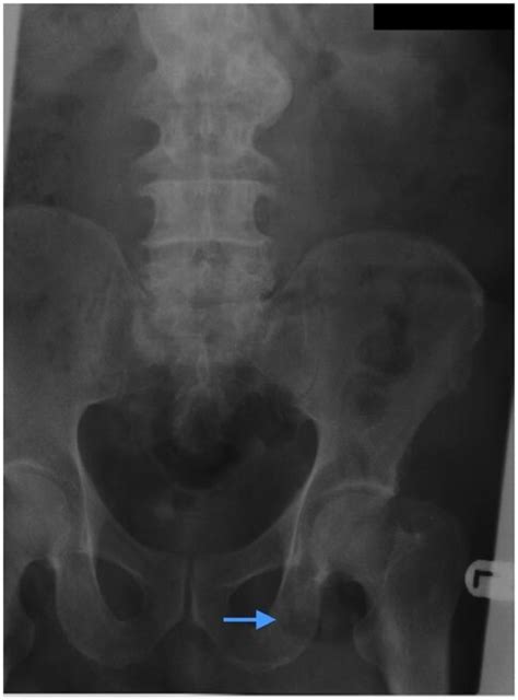 A Abdominal Radiograph Showing Tubular Air Lucency Blue Arrow