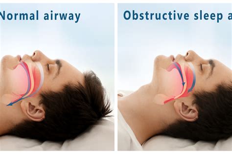 Obstructive Sleep Apnea Icd 10 Mn Heart