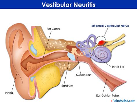 Neuritis Vestibular Neuritis Exercises