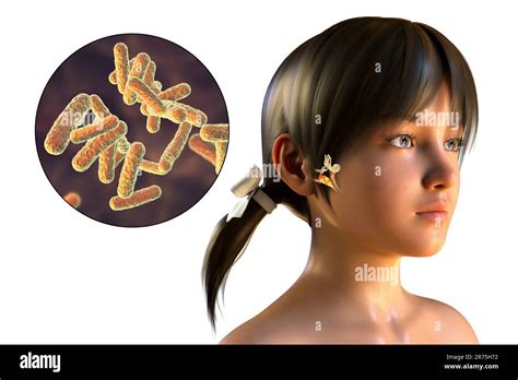 Otitis Media A Group Of Inflammatory Diseases Of The Middle Ear