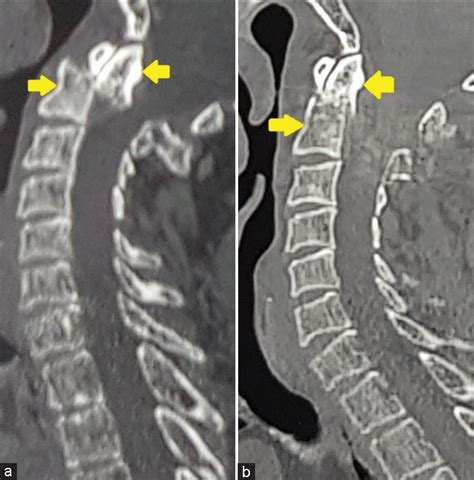 Odontoid Fracture