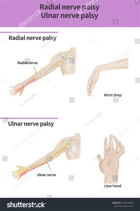 Radial Nerve Anatomy Radial Nerve Palsy And Radial Nerve Message With