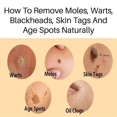 Natural Remedies For Treating Age Spots Moles Skin Tags Warts And