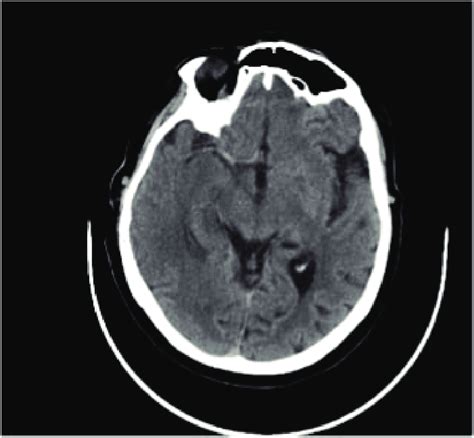 The Brain Ct Shows A Hyperdense Right Middle Cerebral Artery In The