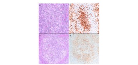 Histopathologic Features Of Nodal T Follicular Helper Tfh Cell