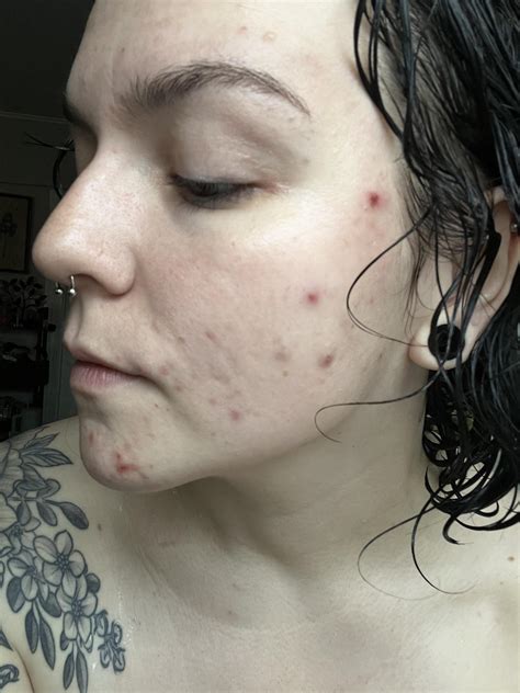 Tips For Post Picking Acne Scrolller